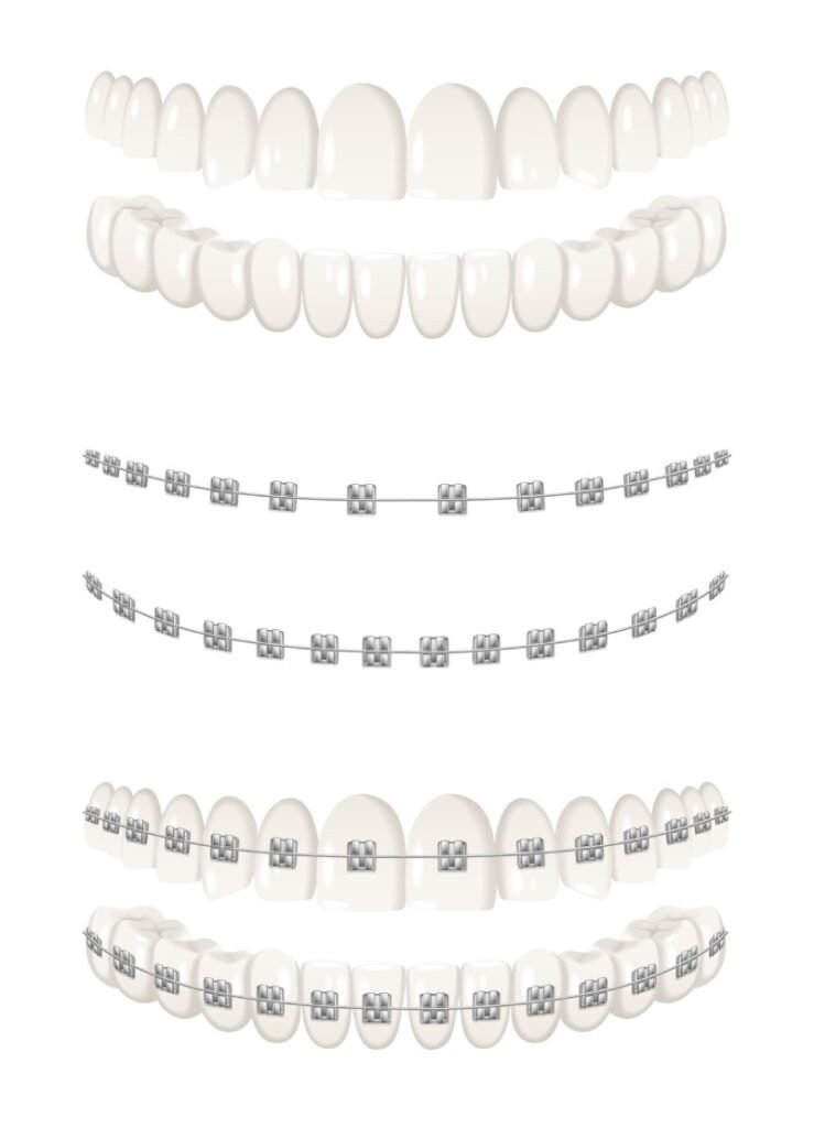 Orthodontic Braces – Straighten Your Smile with The Right Dentist